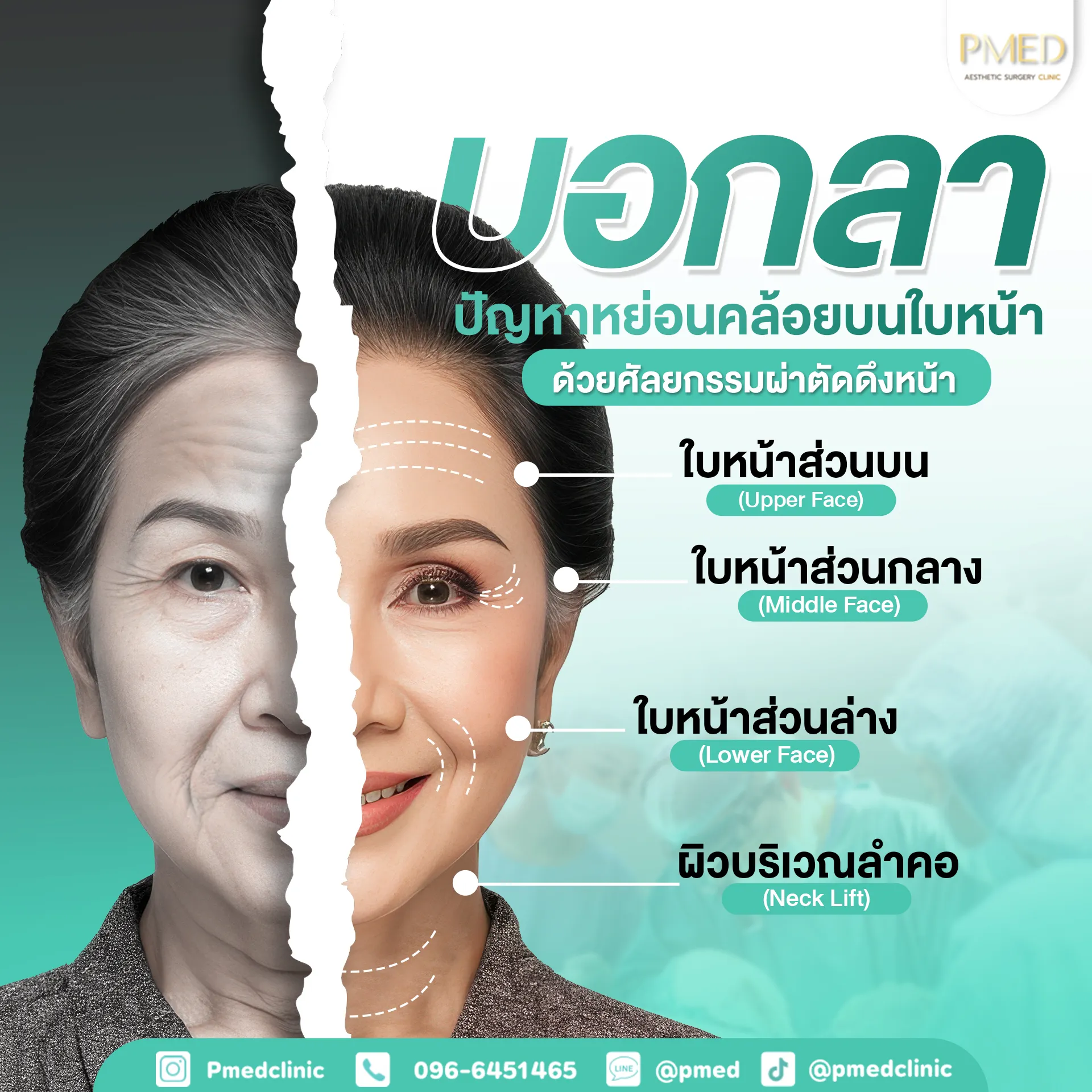 ศัลยกรรมดึงหน้า - PMED Clinic